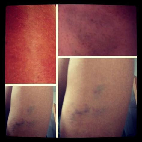 Random Bruises On Legs Qusttennis