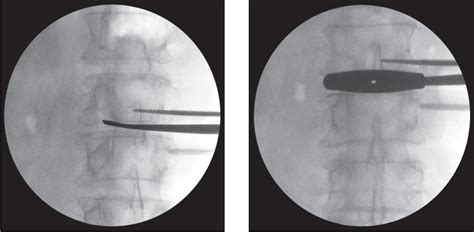 The New Lumbar Spinal Fusion Technique Minimally Invasive Trans Psoas Approach Direct Lateral
