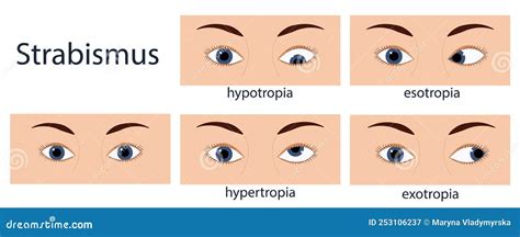 Strabismus Flat Style Infographic Set Of Stages Normal And Disorders European Person Cartoon