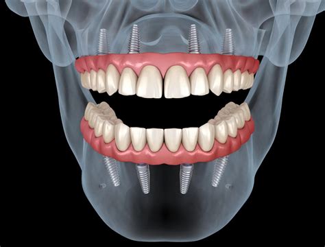 What Makes All On X A More Flexible Option For Full Arch Restoration