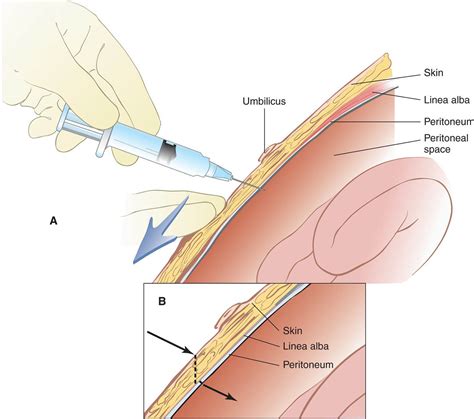 Paracentesis Procedure