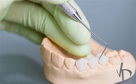 Dental Crowning Procedure Vdm Dental Blog Ny 10014