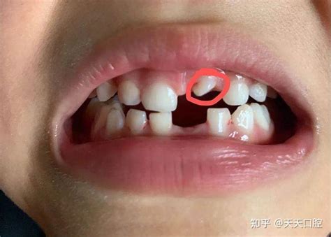 孩子乳牙掉了，恒牙迟迟不长怎么回事？ 知乎
