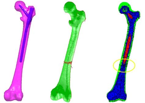 Finite Element Analysis Modelling Of Proximal Femoral Fractures Including Post Fixation