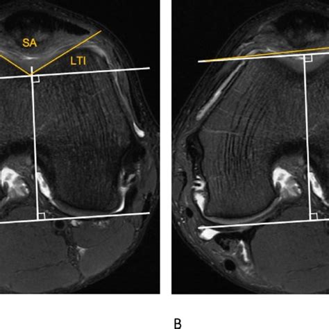 Sagittal Proton Density Weighted Fat Suppressed Mri Shows Assessment Of