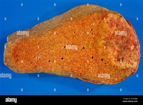 Liver Cancer Gross Specimen Of A Liver With Hepatic Cancer And Cirrhosis At Right Is A