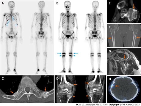 Osteomalacic Pelvis Osteomalacia As A Result Of Vitamin D Deficiency