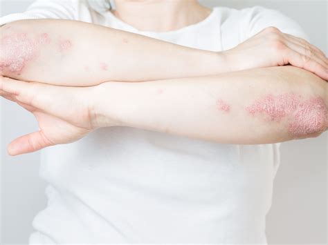 Psoriatic Arthritis The Basics Connected Rheumatology