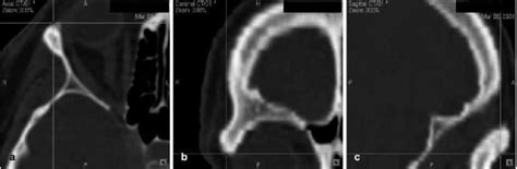 Frontozygomatic Suture