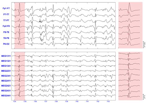 Ieds In Eeg And Meg Signals Portion Of Simultaneously Recorded Scalp Download Scientific
