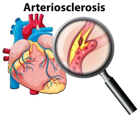 Arteriosklerosis Gejala Penyebab Diagnosis Pengobatan Idn Times