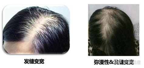 年纪轻轻开始脱发怎么办？ 知乎