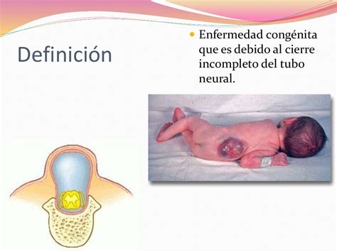 Cuidados De Enfermeria Meningocele