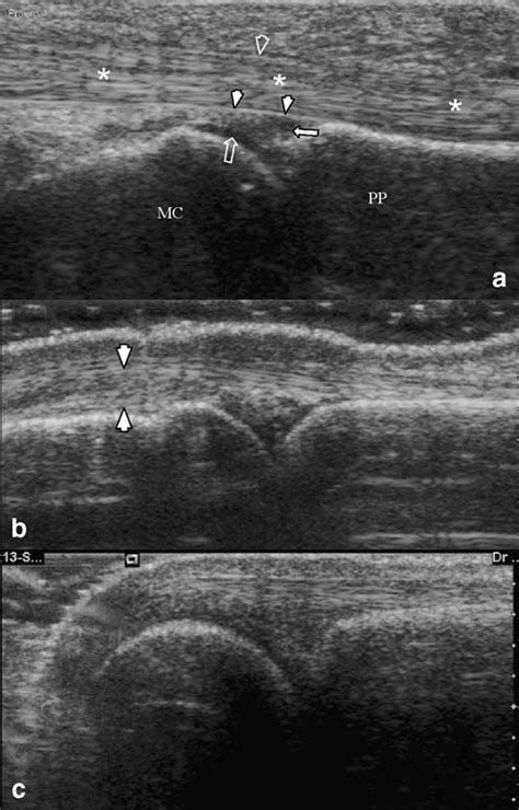 A Long Axis Sagittal View Of The Flexor Aspect Of The Download Scientific Diagram