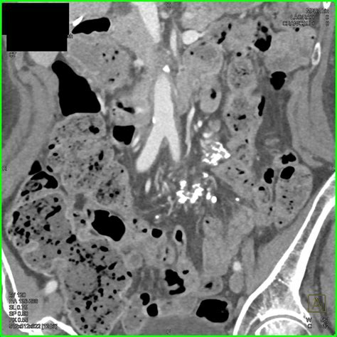 Sclerosing Mesenteritis Small Bowel Radiology Case Studies Ctisus