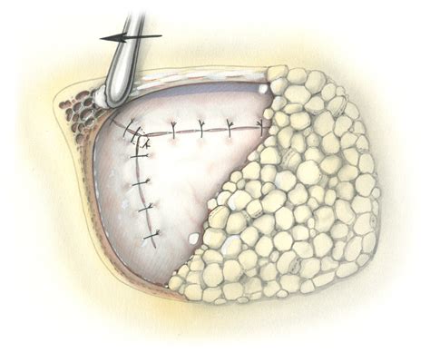 Retrosigmoid Approach Skull Base Surgery Atlas