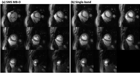 fig 2 direct comparison of whole heart perfusion imaging atmiddle time frame using single band