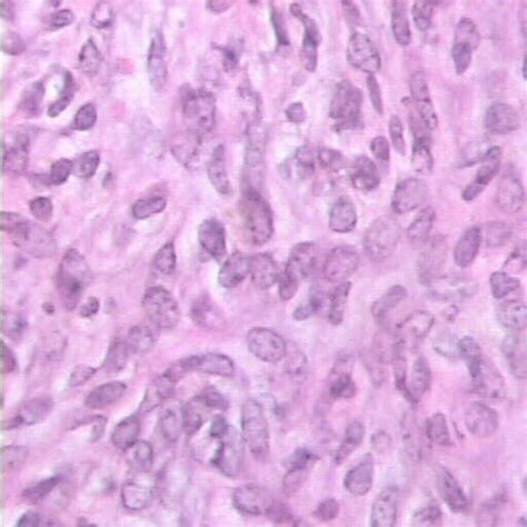 Uterine Leiomyosarcoma Distinctive Pleomorphic Cells With Vesicular