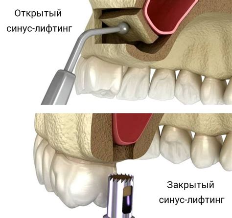Закрытый и открытый синус лифтинг в Тольятти в СК Классика
