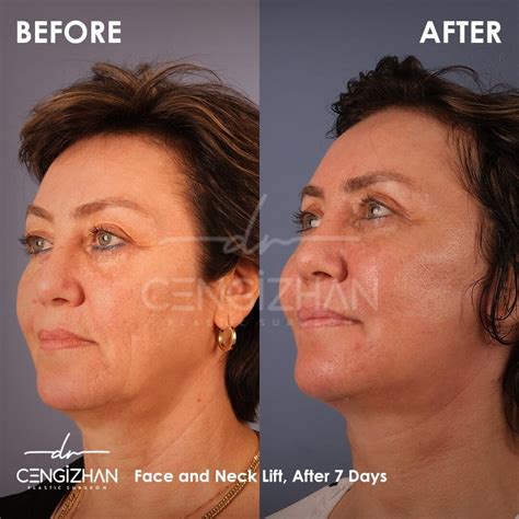 Facelift In Turkey Results Dr Cengizhan Ekizceli