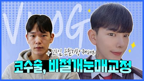 Vlog 성형으로 내가 원하던 모습을 얻었다 👍 남자성형 코성형 비절개눈매교정 앞트임 눈밑지방재배치 Youtube