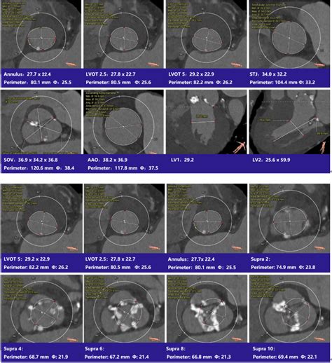 双管齐下｜中国医大一院瓣膜介入团队成功完成经导管主动脉瓣置换术（tavr） 经皮二尖瓣球囊扩张成形术（pbmv）一站式手术 严道医声网