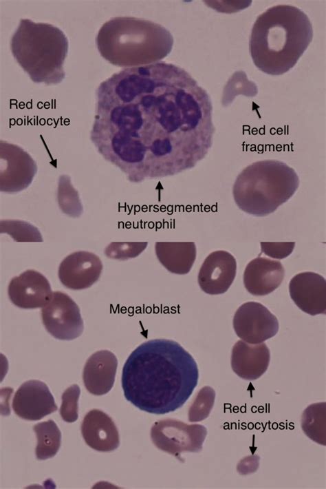 A Student With Macrocytic Anaemia The Bmj