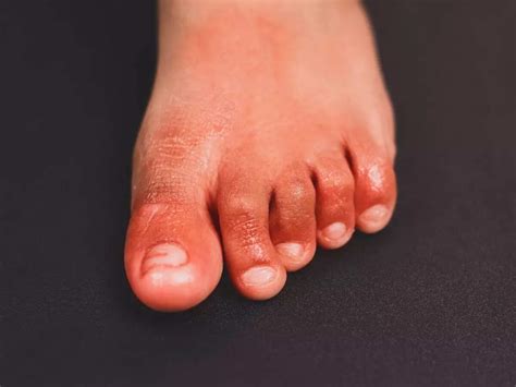 From Hairy Tongue To Covid Toe 5 Unusual Covid Symptoms