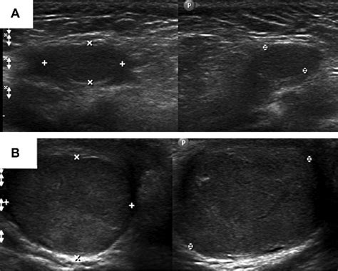 A Sonographic Appearance Of Right Undescended Testis Before Download Scientific Diagram