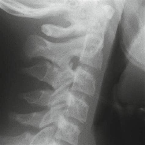 Pdf Reliability Of The Cervical Vertebrae Maturation Cvm Method