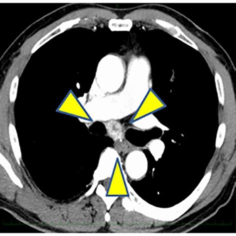 Follow‐up Ct Findings At 1 Year After Surgery For Mrcc Ct Shows A Download Scientific Diagram