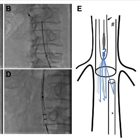 Combination Of Double Sheaths Docking Technique And Loop Snare