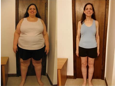 Mini Gastric Bypass Before And After Photos Mexico Ba