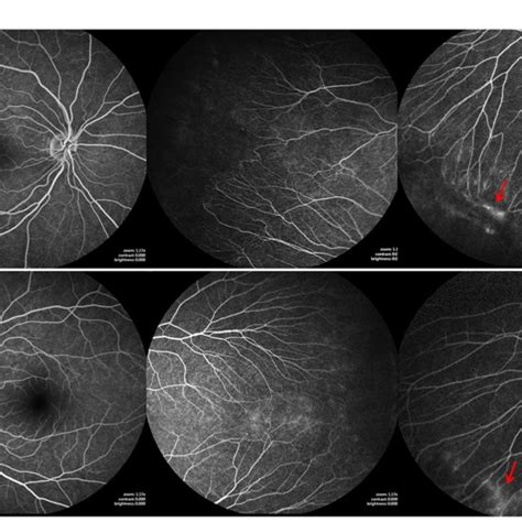 Figure Fundus Fluorescein Angiography Ffa Findings Of The Father Of Download Scientific