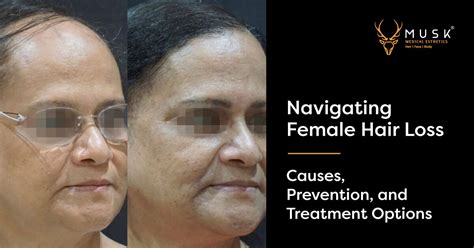 Contraceptive Hair Loss Treatment