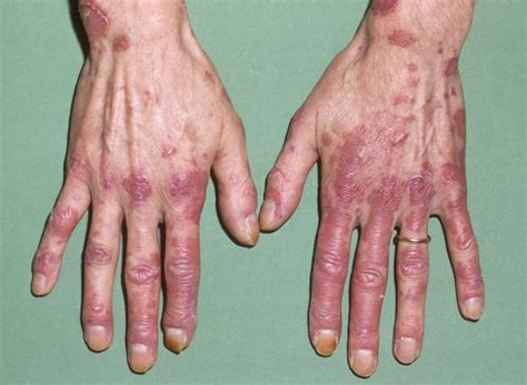 Lupus Rash On Hands
