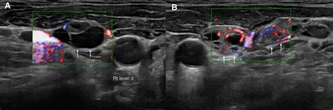 Ultrasonography Shows Hyperechoic Lymph Nodes Enlargements Arrows