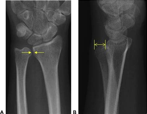 Figure 2 From Bidirectional Dislocation Of The Distal Radioulnar Joint After Distal Radius