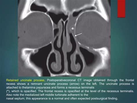 Failed Fess Spectrum Of Ct Findings In The Frontal Recess Ppt