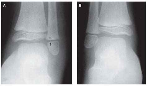Ankle Radiology Key