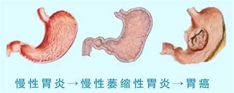 萎缩性胃炎是可以逆转的 健康160
