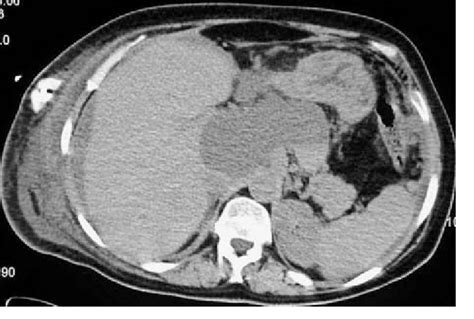 Computed Tomography With Contrast Material Injection Through The
