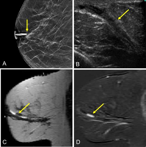 Intraductal Papilloma Of Breast Pacs