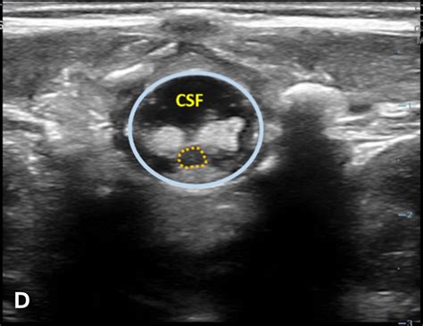 Ultrasound Assisted Lumbar Puncture In Infants Em Ultrasound Section