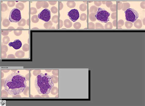 Obs A5 Un Message Dalerte Sur Lhémogramme Dune Femme De 20 Ans