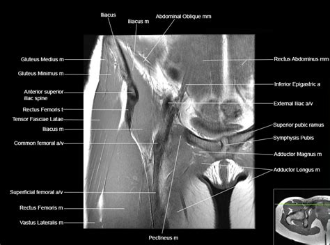 Mri Anatomy Right Hip Acetabular Labrum Mri Hywuy