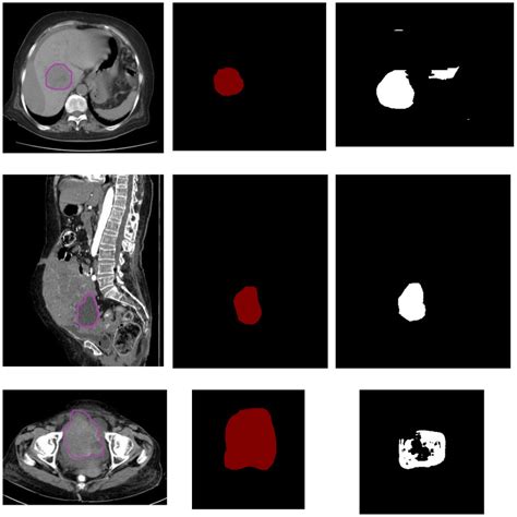 Performance Analysis Of Segmentation And Classification Of Ct Scanned Ovarian Tumours Using U