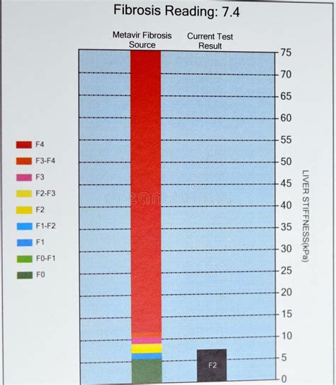 Fibroscan Examination Study Of The Liver Revealed F2 For Liver Stiffness S3 For Liver Steatosis