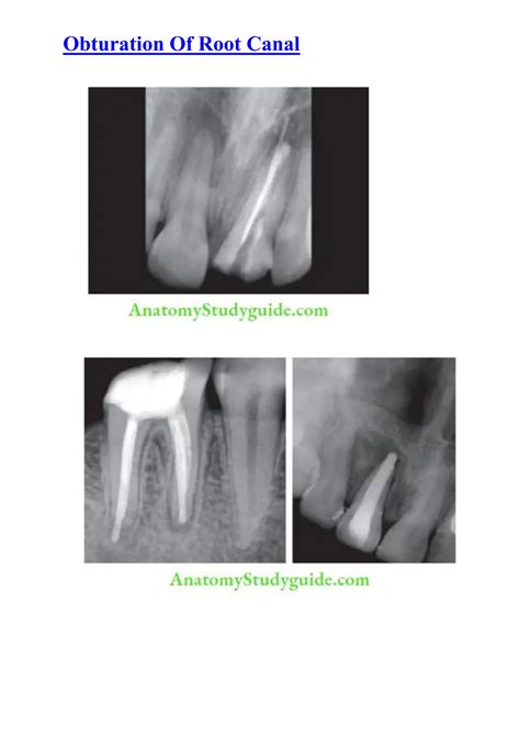 Obturation Of Root Canal Obturation Of Root Canal Pdf