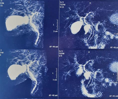 Magnetic Resonance Cholangiopancreatography Mrcp Findings Mrcp At Download Scientific